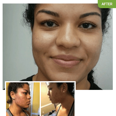 Exposed Skin Care Results | Before and After Skin Care Pictures