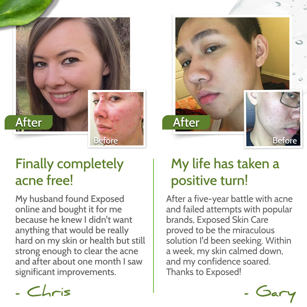 Basic Kit Acne Treatment System | Exposed Skin Care